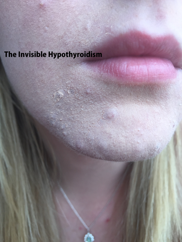 Worsening Acne With Hypothyroidism