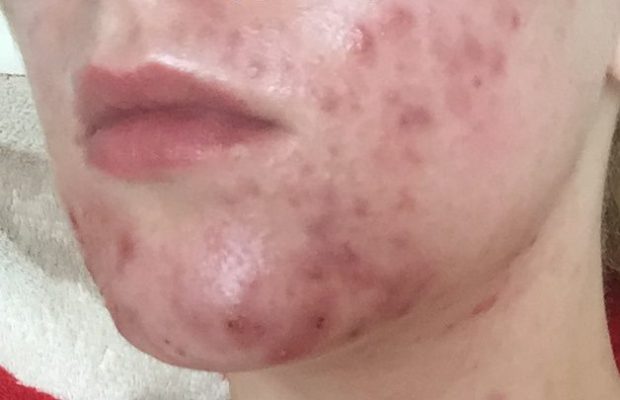 7 Ways Hypothyroidism Affects Your Appearance - The Invisible ...