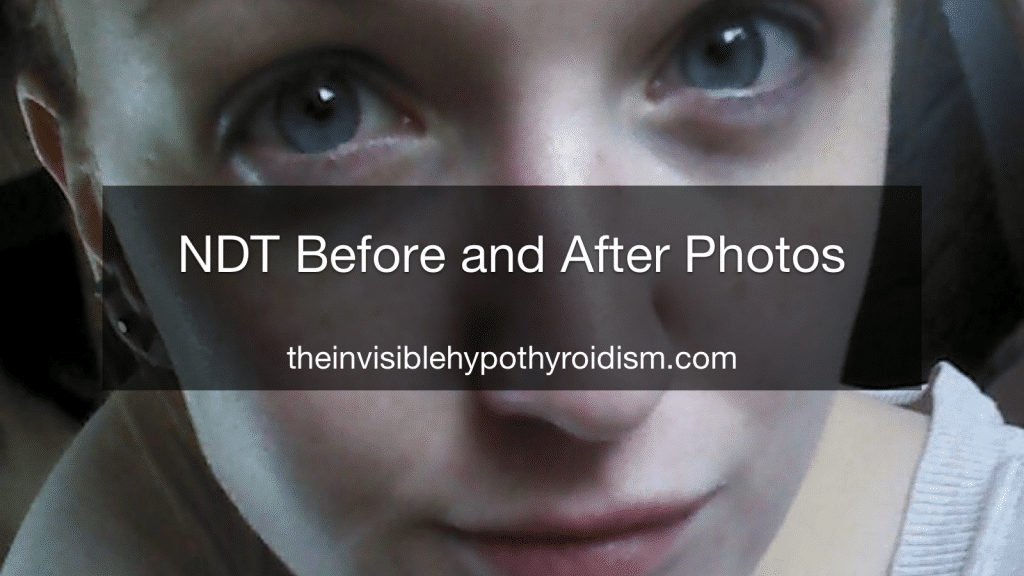 How Do You Treat Hashimoto's?