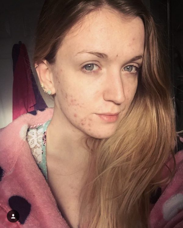 Is Your Thyroid Behind Your Acne?
