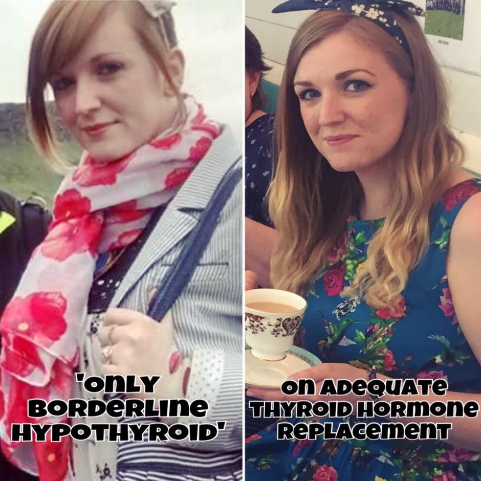 Untreated 'Borderline Hypothyroidism' Leaves Many Thyroid Patients Unwell