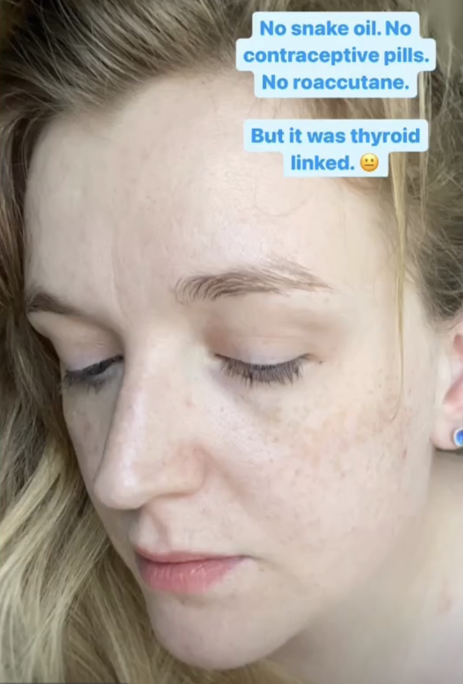 Is Your Thyroid Behind Your Acne?